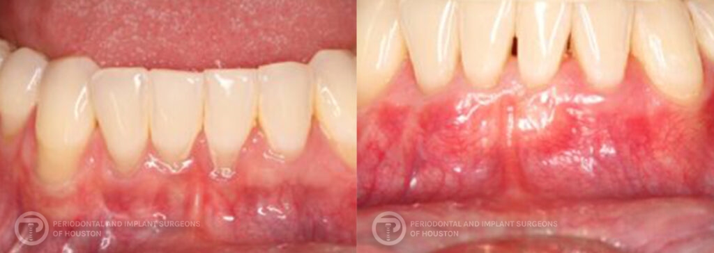 Before & After AlloDerm® Gallery | Houston, TX