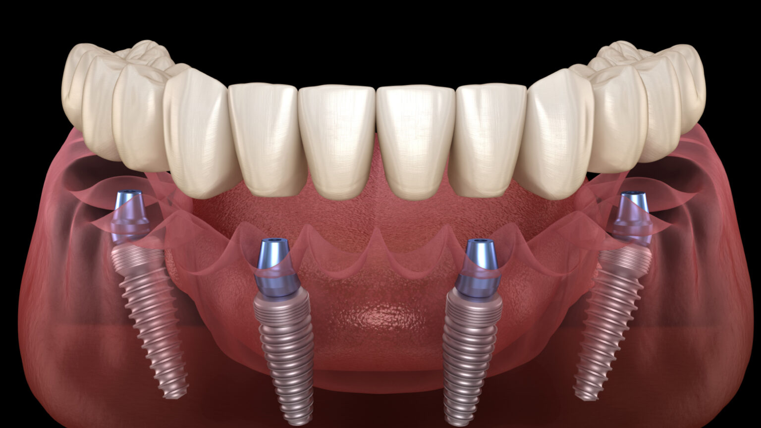 All on 4 Dental Implants : Is It Right for Severe Bone Loss?